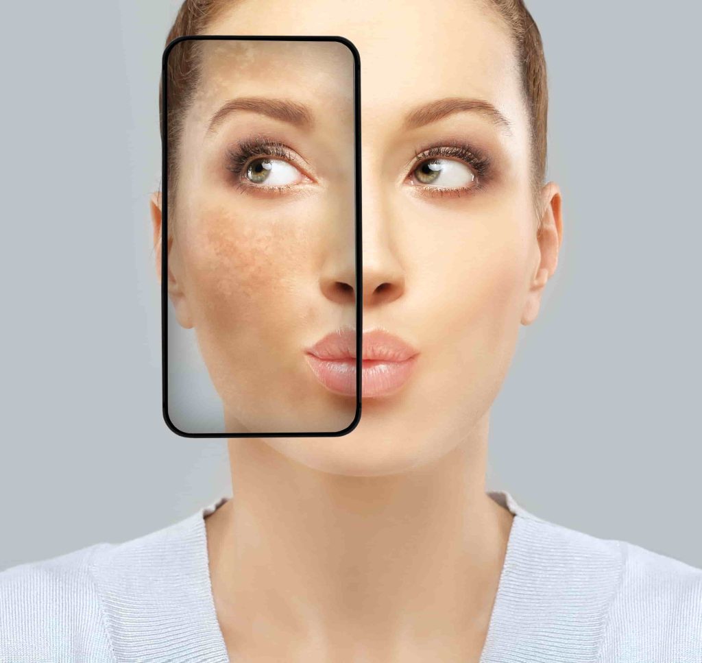 Best Melasma Treatment in Hyderabad | Srih Skin Clinic
